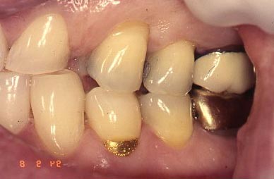 V.5 - Gold Fillings and Inlays - the Ultimate Dentistry – The Center ...