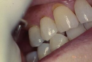 Toothbrush Abrasion or Dental Abfraction? - III.5 – The Center for ...