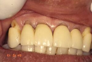 Toothbrush Abrasion or Dental Abfraction? - III.5 – The Center for ...