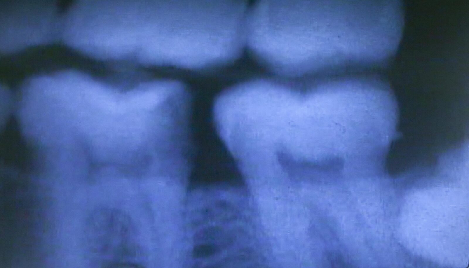 Tooth Pulp Infection - III.3 – The Center for Dental Education