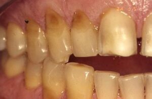 Toothbrush Abrasion or Dental Abfraction? - III.5 – The Center for ...