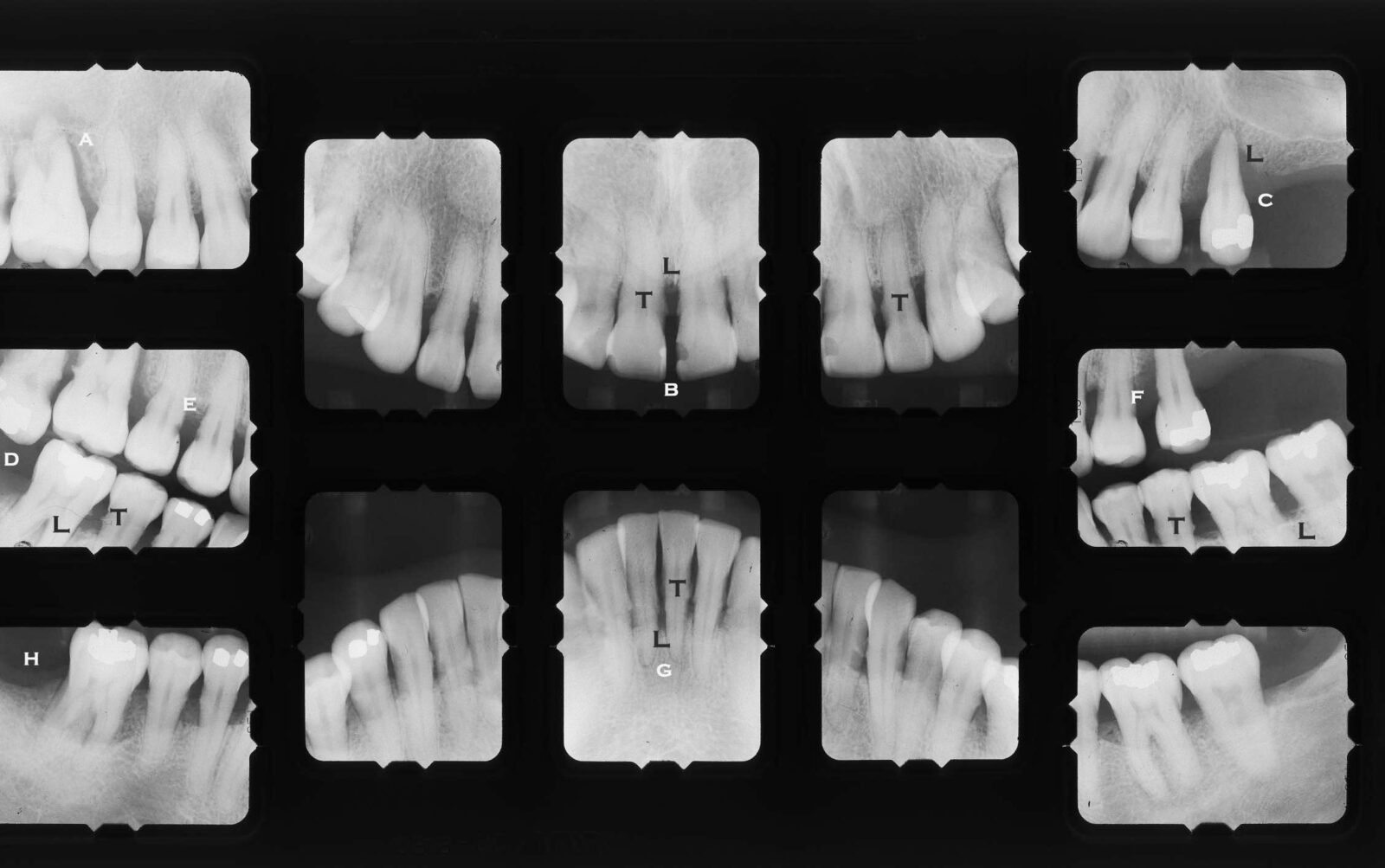 Gum or Periodontal Disease - III.2 – The Center for Dental Education