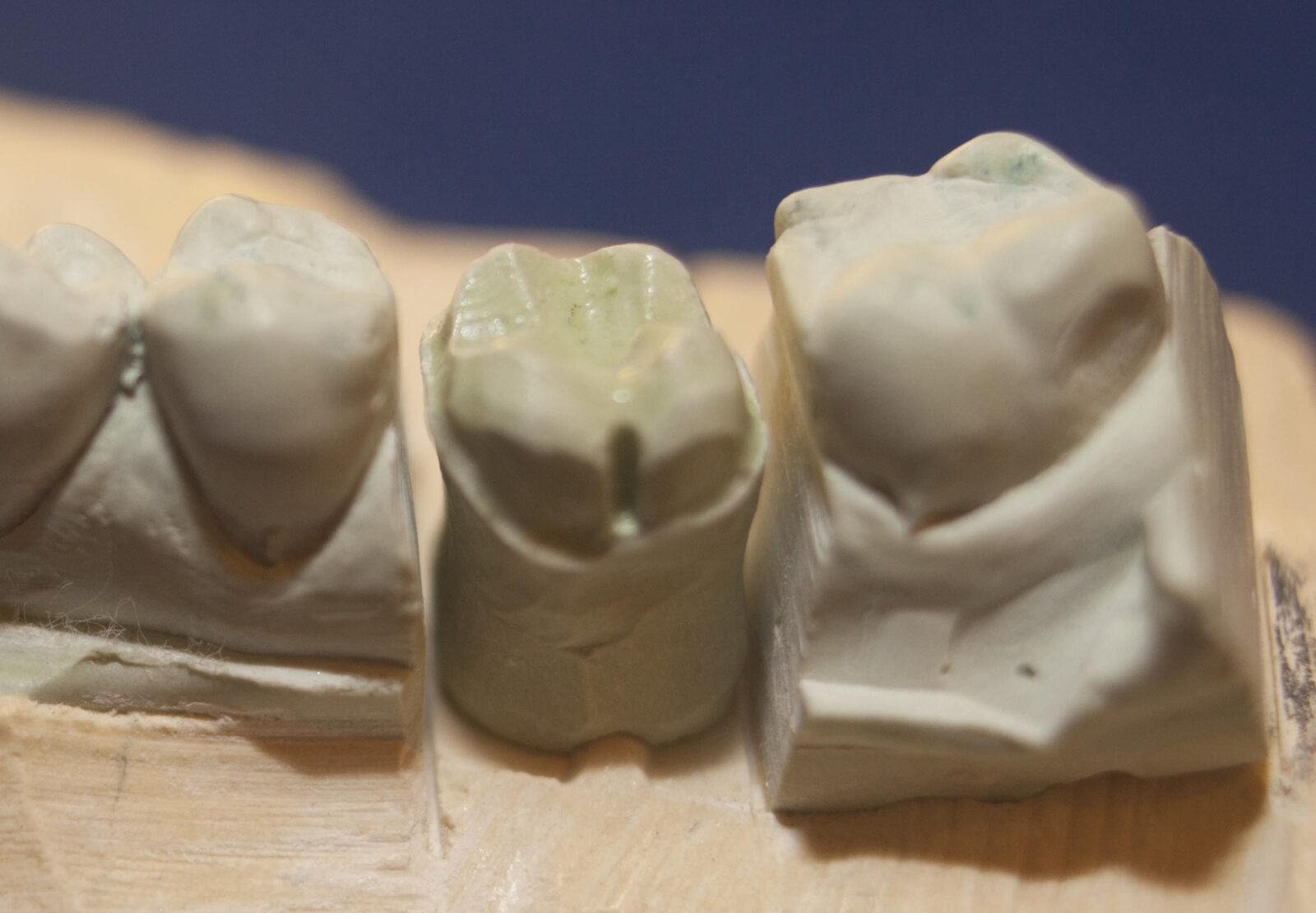 Dental Gold Onlays and Crowns - Posterior Teeth - V.6 – The Center for ...