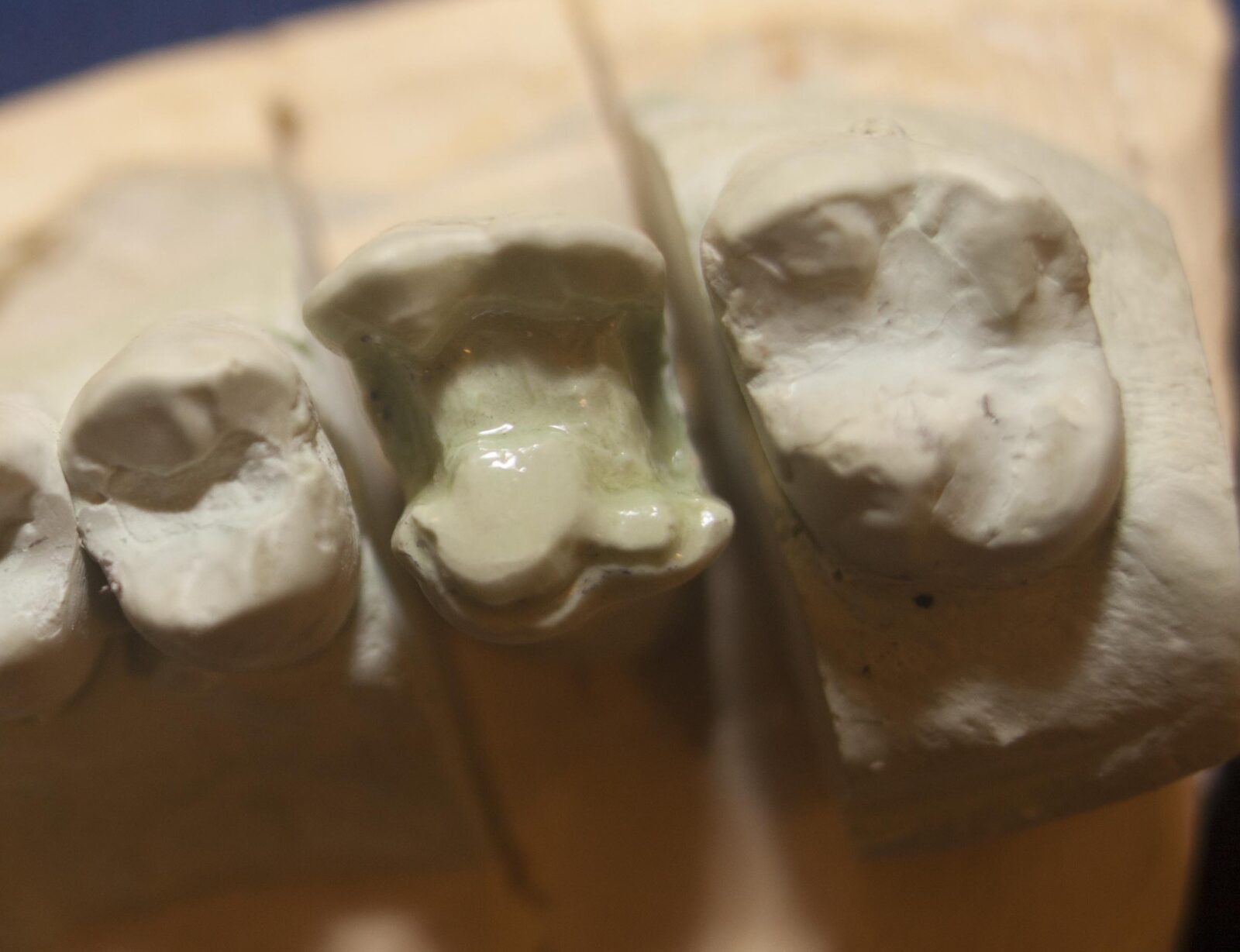 Dental Gold Onlays and Crowns - Posterior Teeth - V.6 – The Center for ...