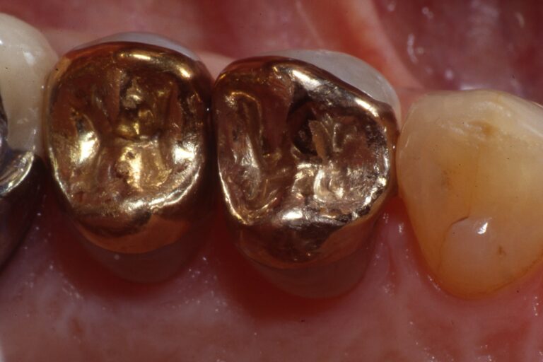 Dental Gold Onlays and Crowns - Posterior Teeth - V.6 – The Center for ...