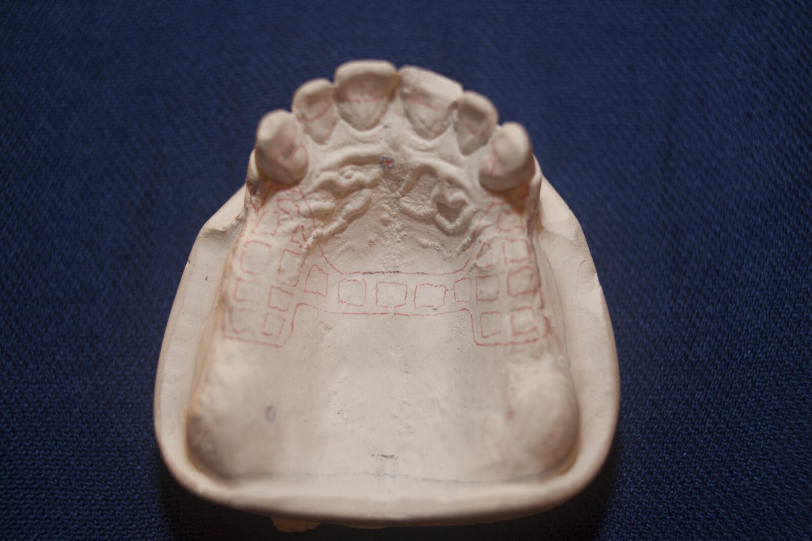 Tooth Replacement - V.13 – The Center for Dental Education