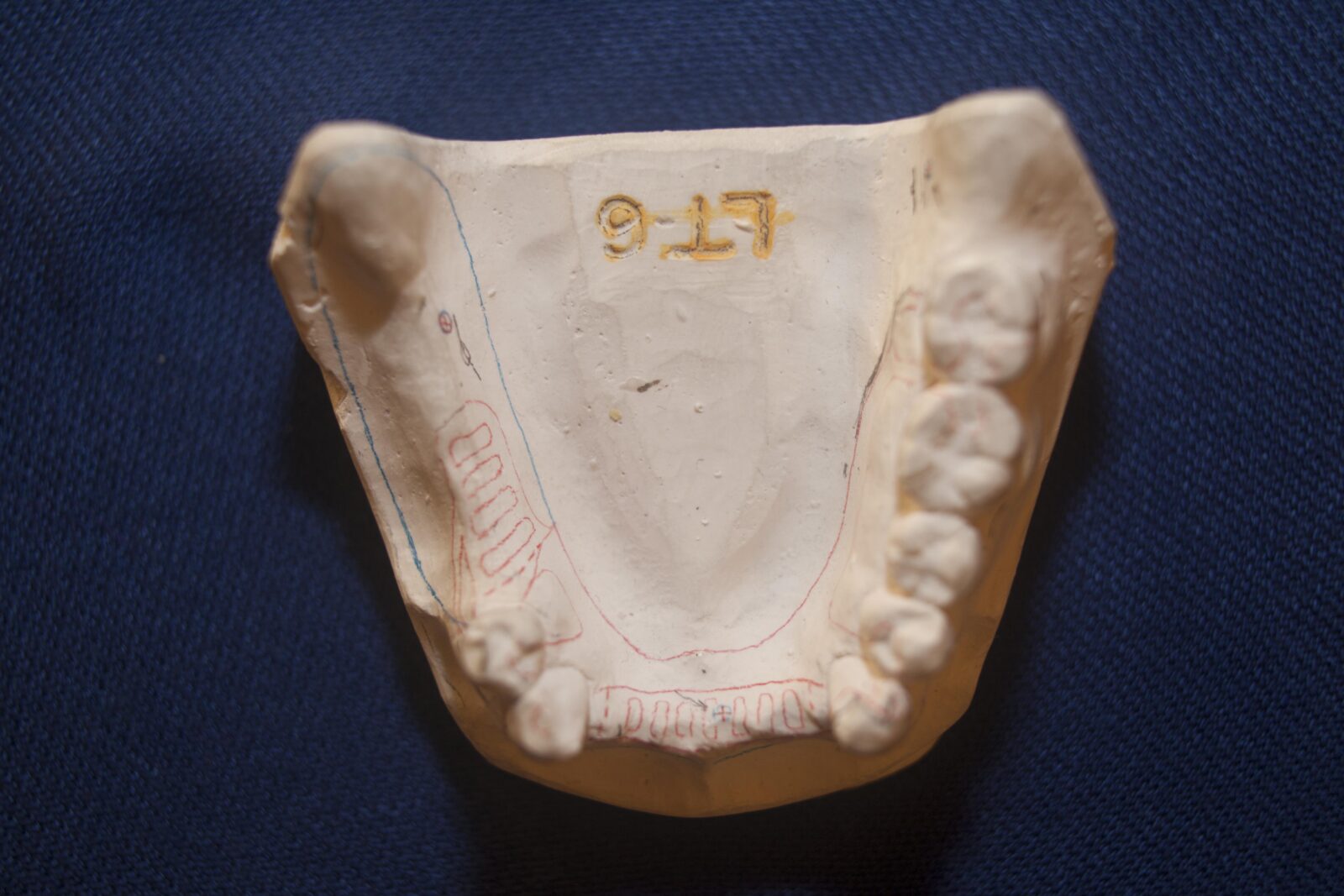 Tooth Replacement - V.13 – The Center for Dental Education