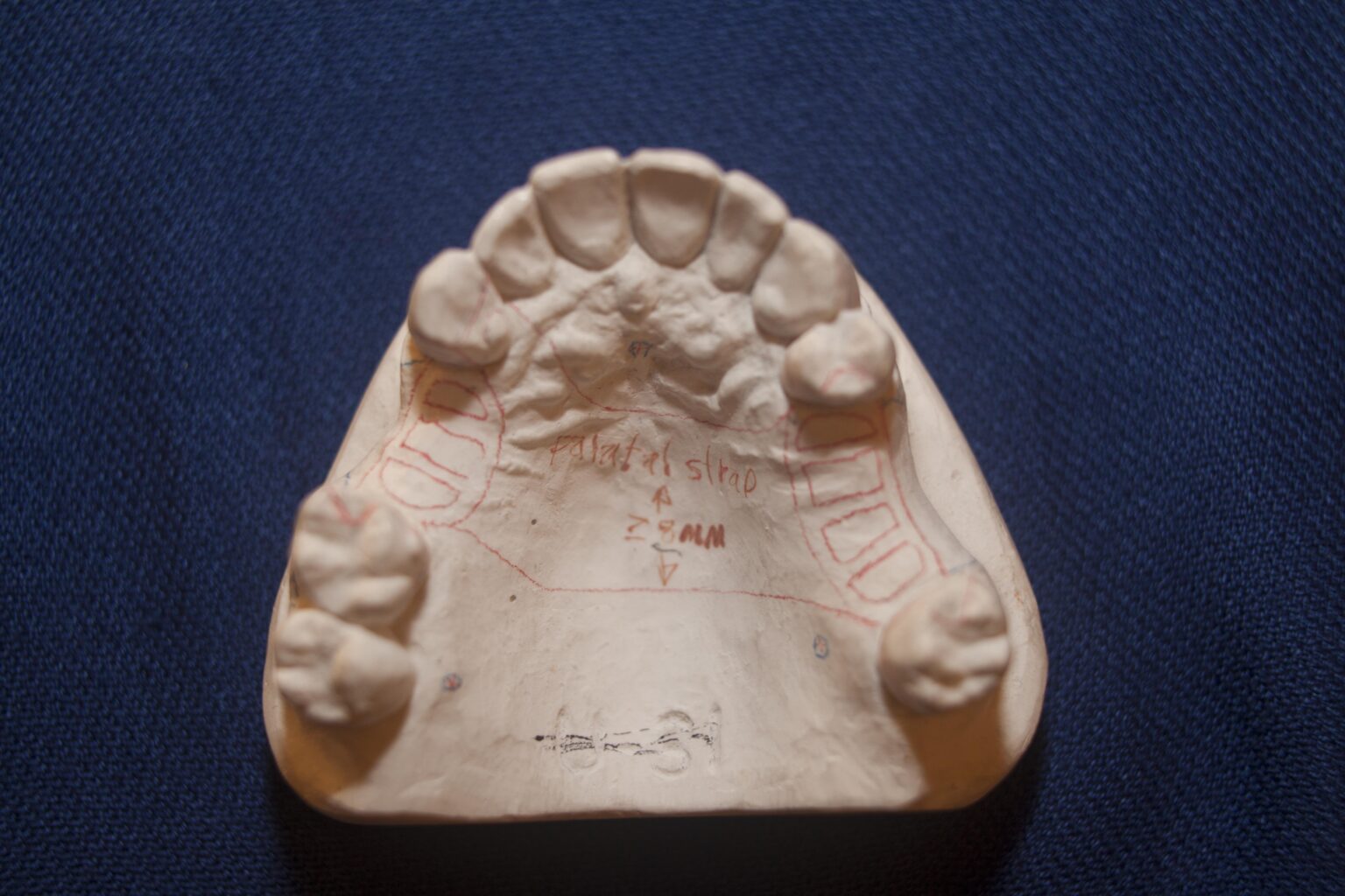 Tooth Replacement - V.13 – The Center for Dental Education