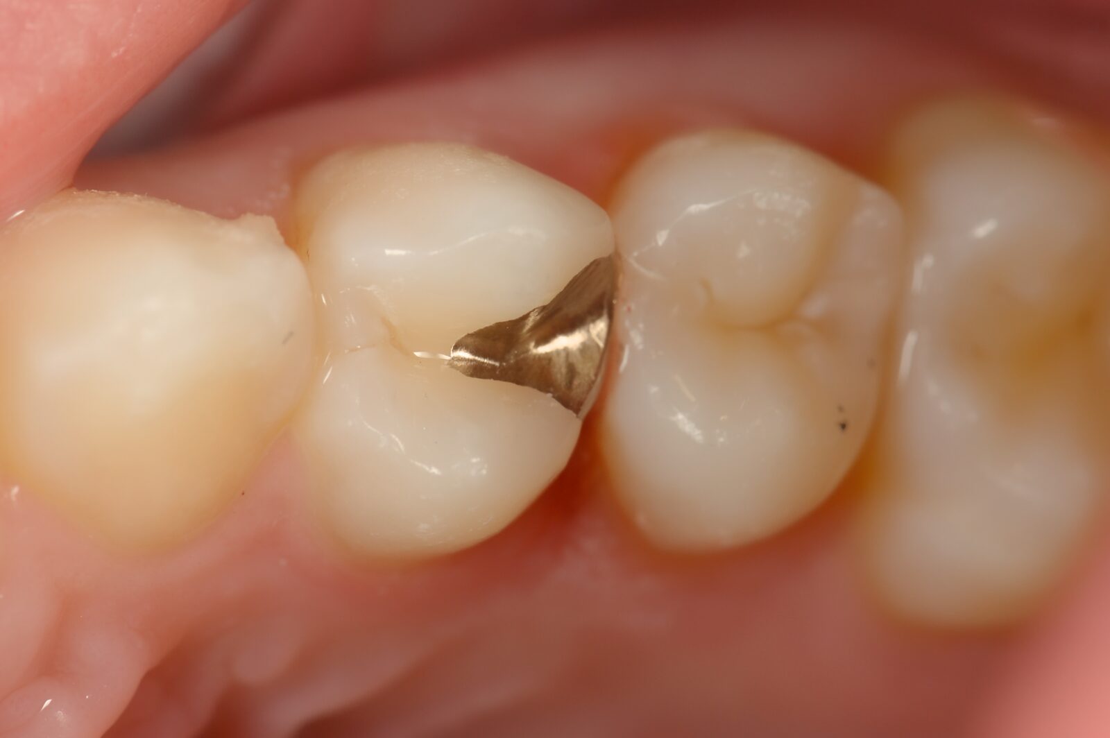 Dental Gold Fillings and Inlays - the Ultimate Dentistry - V.5 – The ...