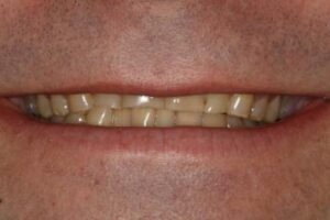 The Collapsed Dental Bite - V.15 – The Center for Dental Education